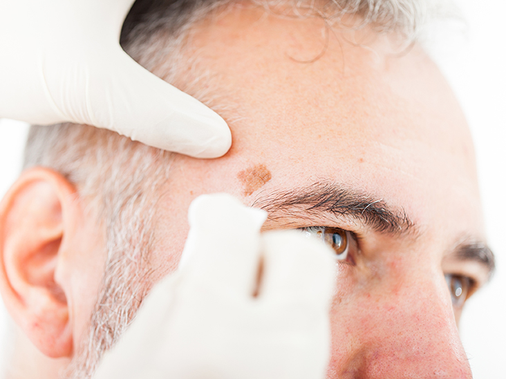 Facial Aging Spots: Causes and Removing Methods | New Health Advisor