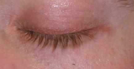 Know the Causes and Best Ways to Deal with Dry Corner of Your Eyes ...