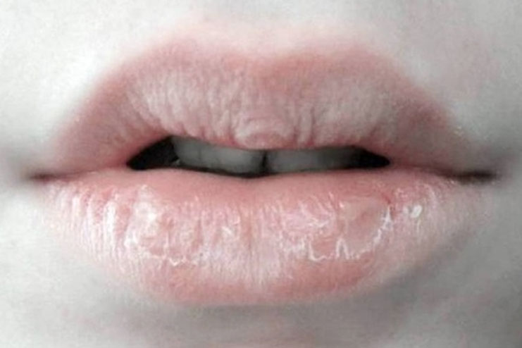 Why Do Lips Get Chapped When You're Sick? | New Health Advisor